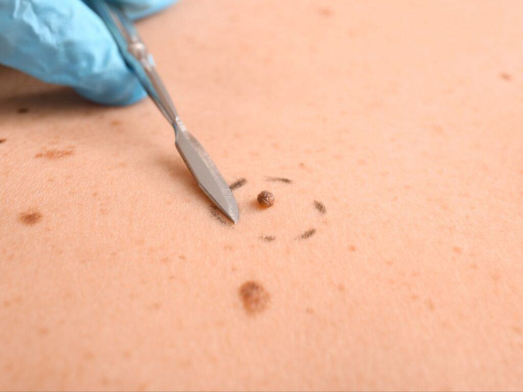 Atypical Moles: What They Mean and When to Worry